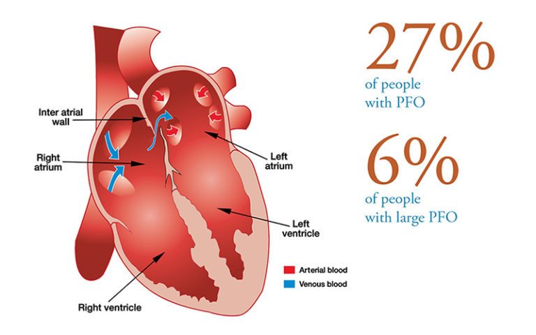 Guidelines for Patent Foramen Ovale and Fitness - DAN World