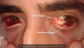 Mask Squeeze (Facial Barotrauma) - DAN World