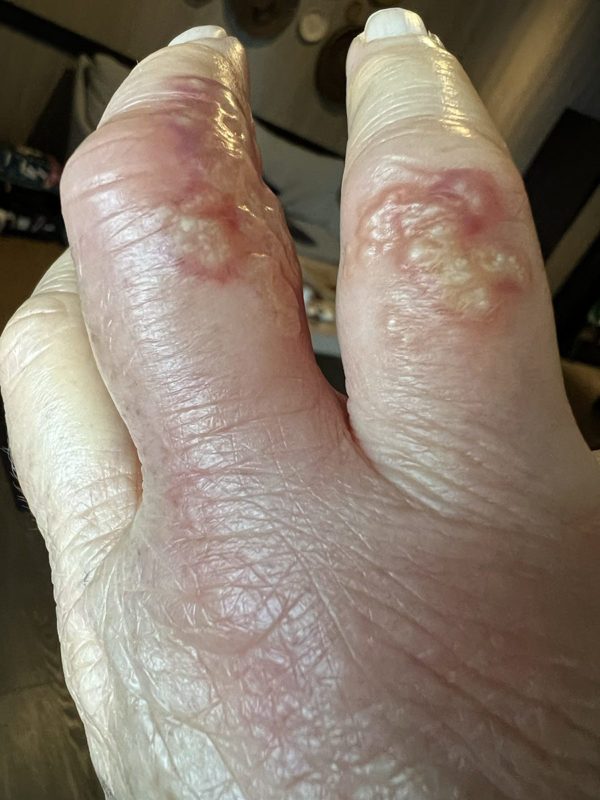 Marine Stings in Remote Locations - DAN World